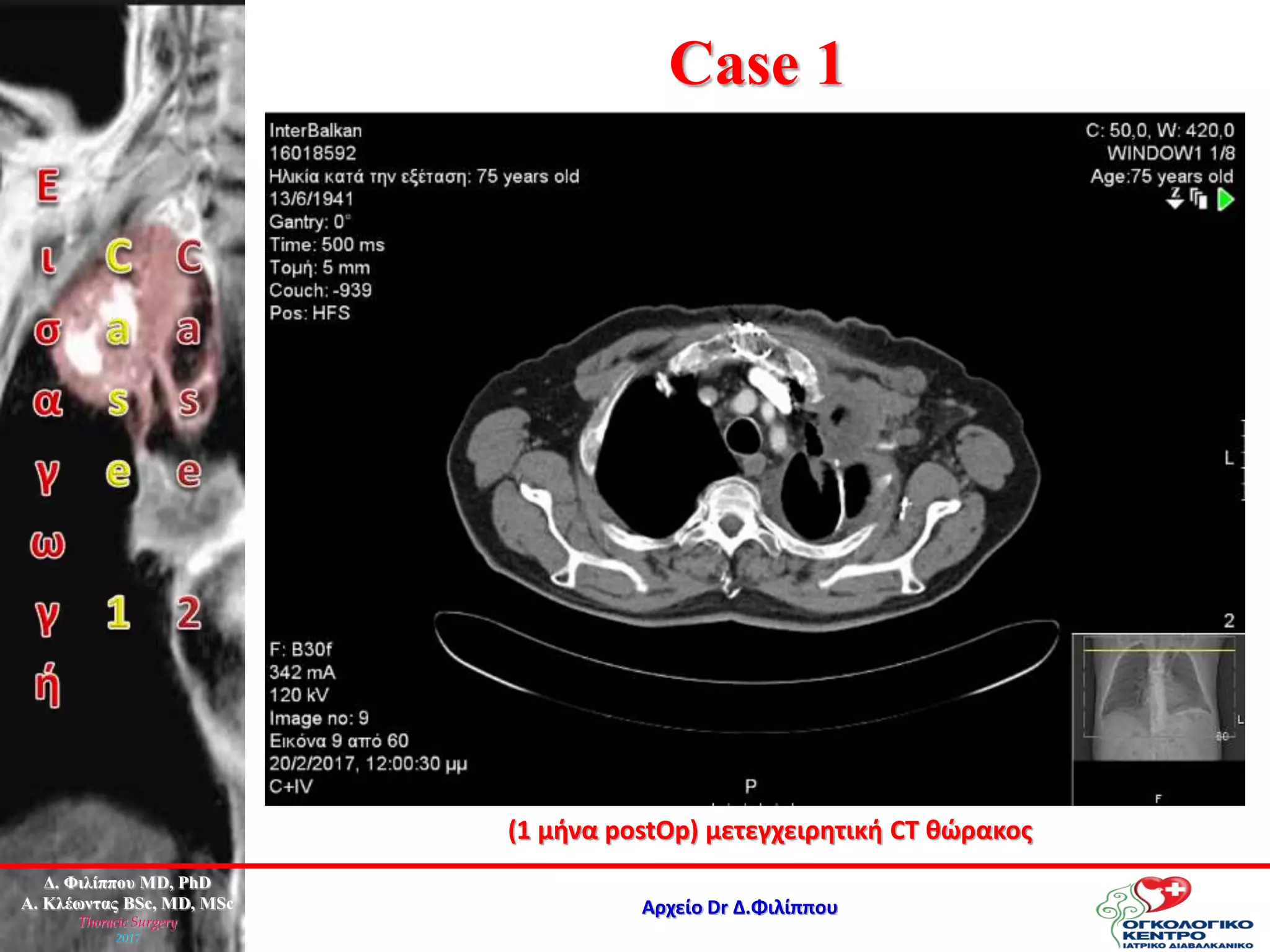 Pancoast (filippou - kleontas) - Όγκοι Pancoast (Φιλίππου - Κλέωντας) | PPT