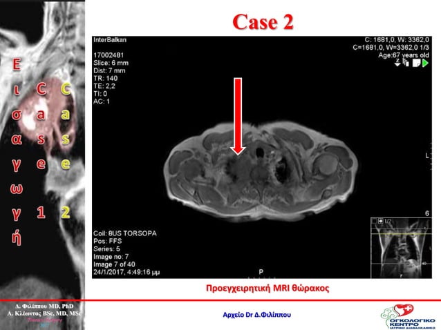 Pancoast (filippou - kleontas) - Όγκοι Pancoast (Φιλίππου - Κλέωντας ...