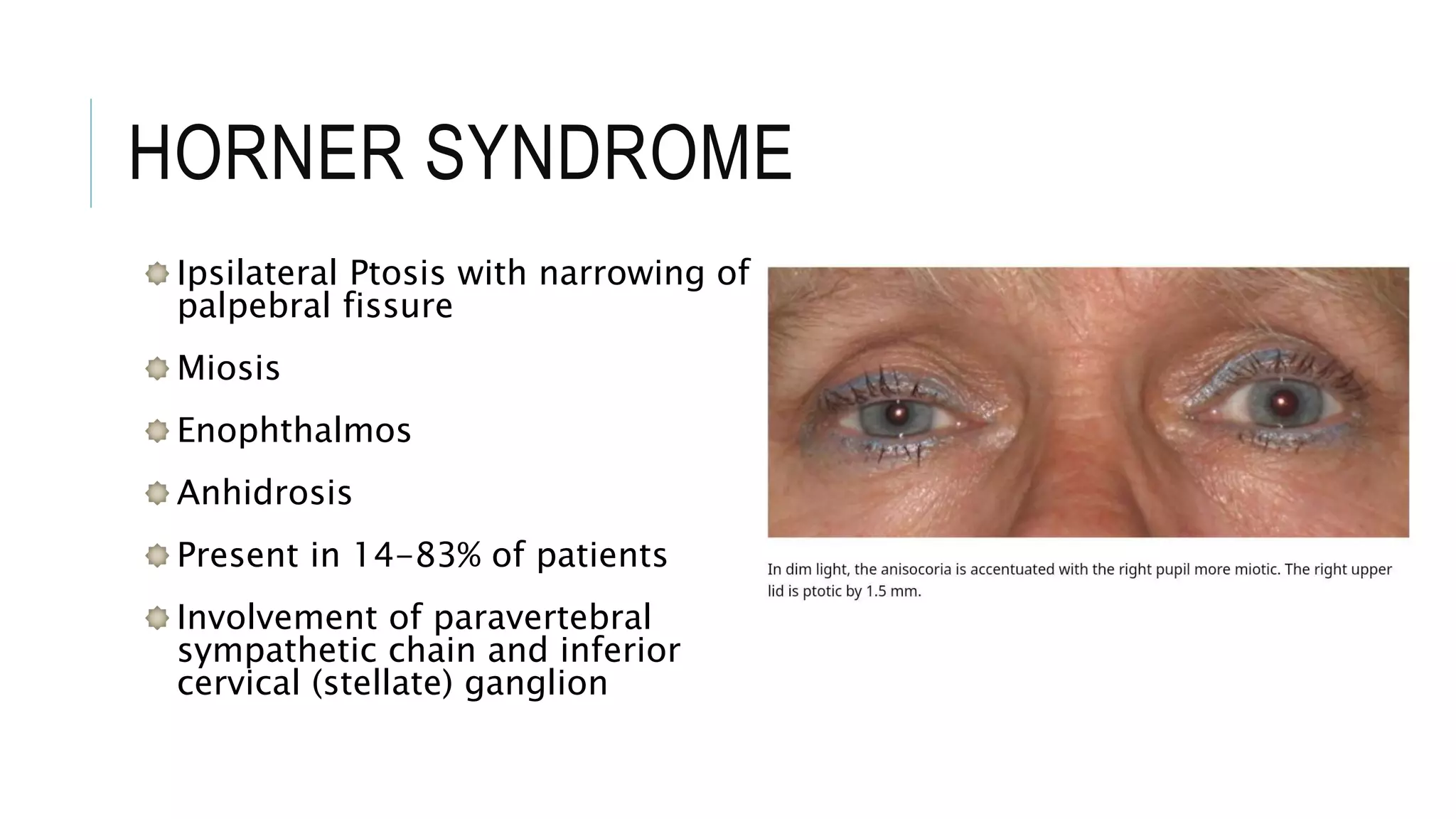 pancoast tumor.pptx