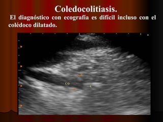 Pancrea-Coledocolitiasis imagenología.ppt