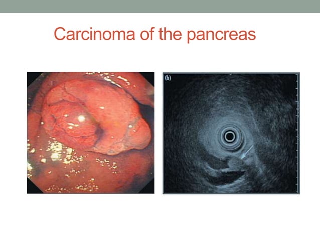 Pancreas | PPT