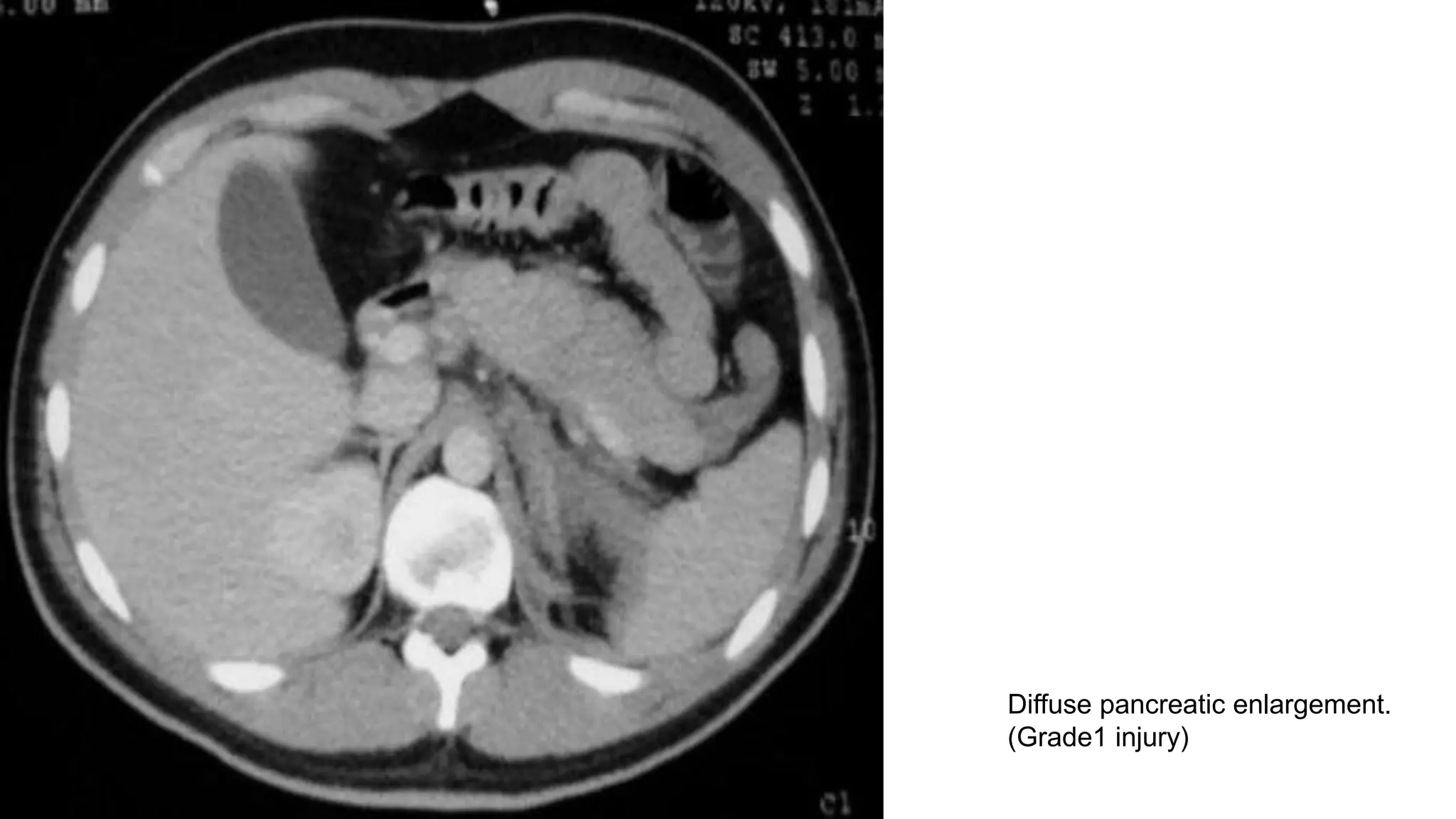 Pancreatic trauma | PPTX