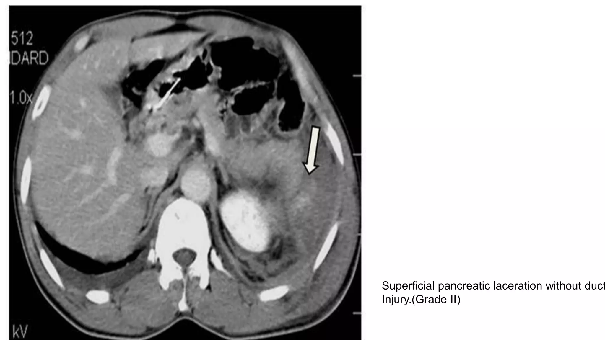 Pancreatic trauma | PPTX