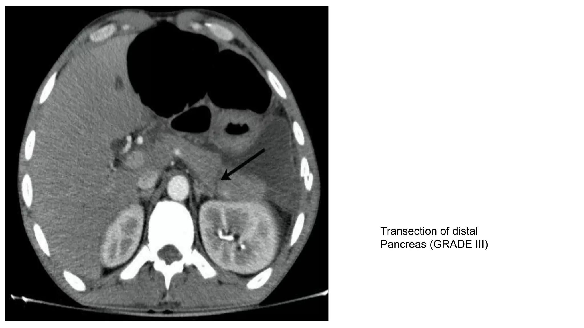 Pancreatic trauma | PPTX