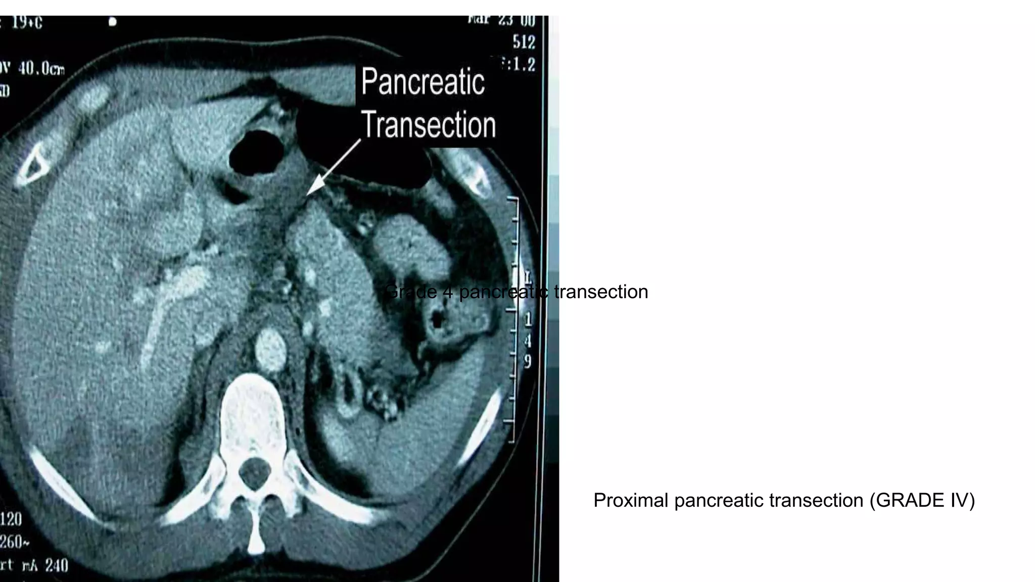 Pancreatic trauma | PPTX