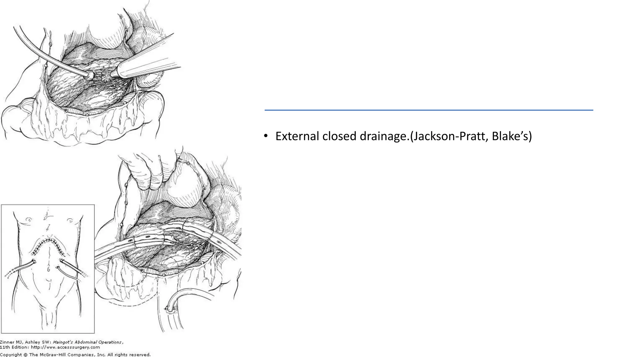 Pancreatic trauma | PPTX