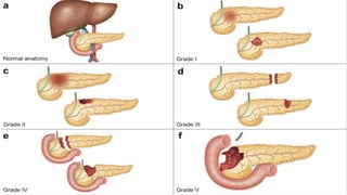 Pancreatic trauma | PPTX