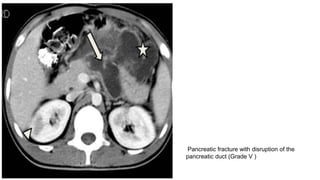 Pancreatic trauma | PPTX