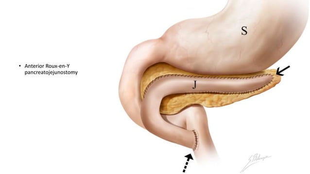 Pancreatic trauma | PPTX