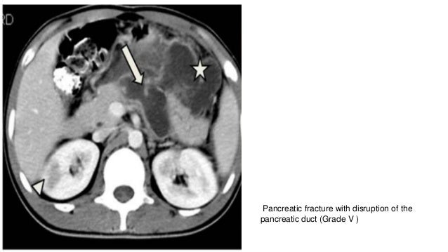 Pancreatic trauma