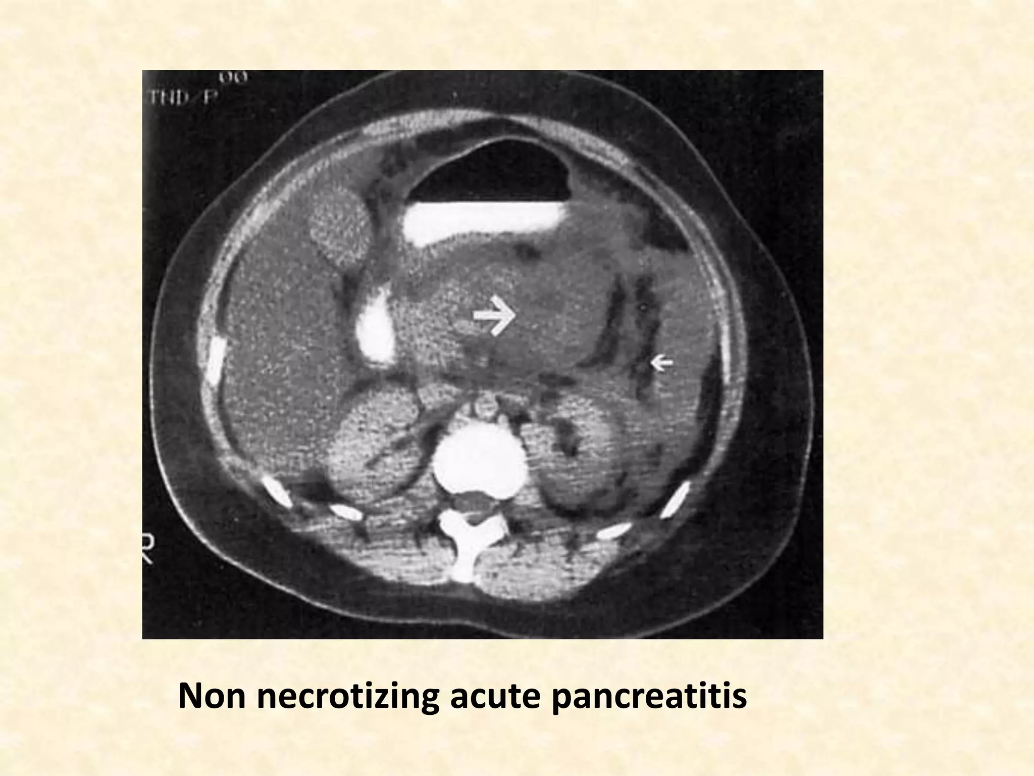 pancreas.ppt