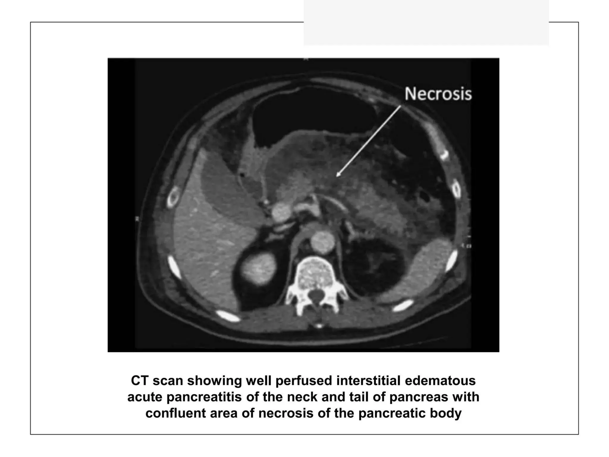 pancreatitis - definition, etiology, clinical features and management ...