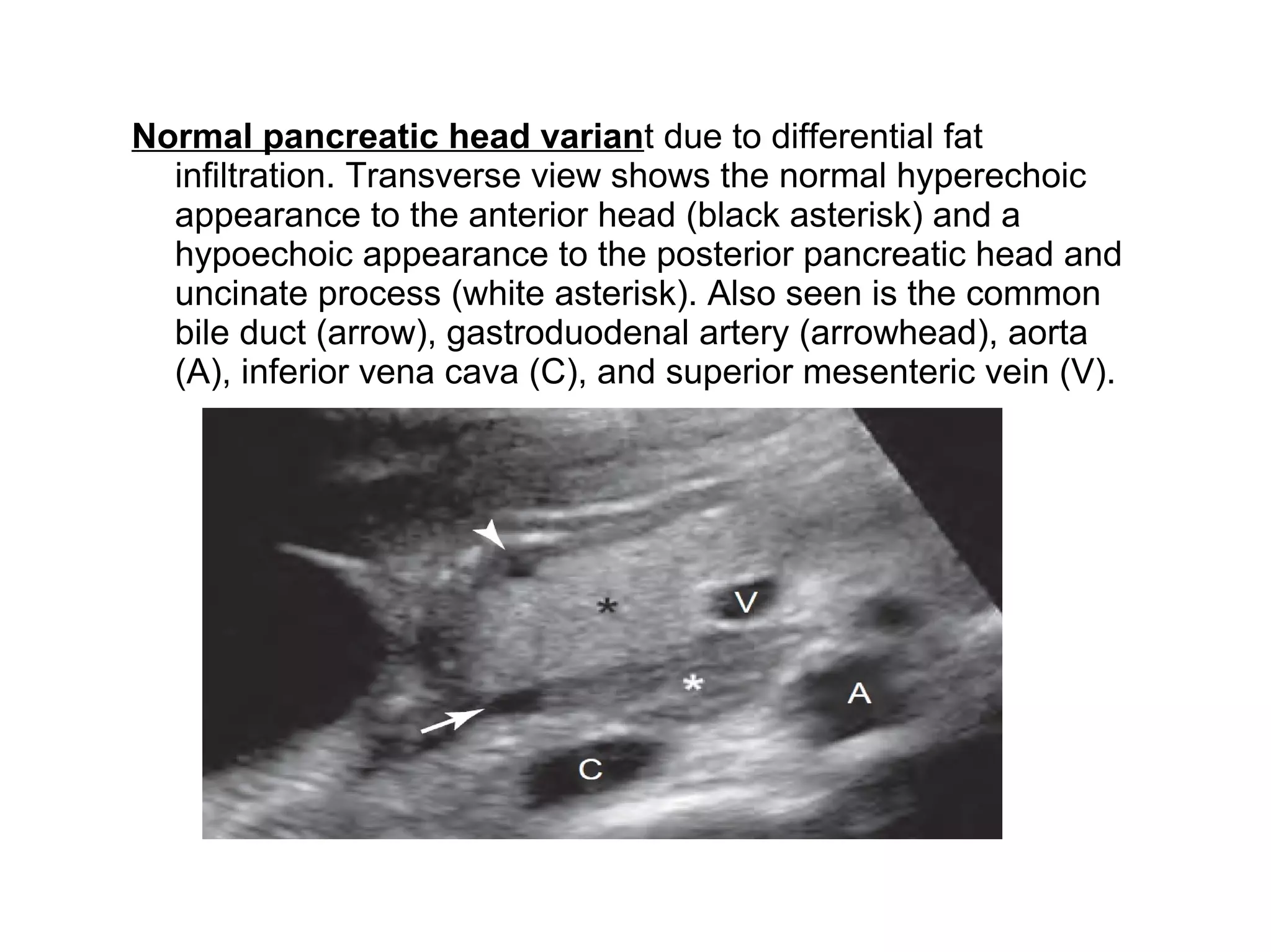 Pancreas ultrasound | PPT