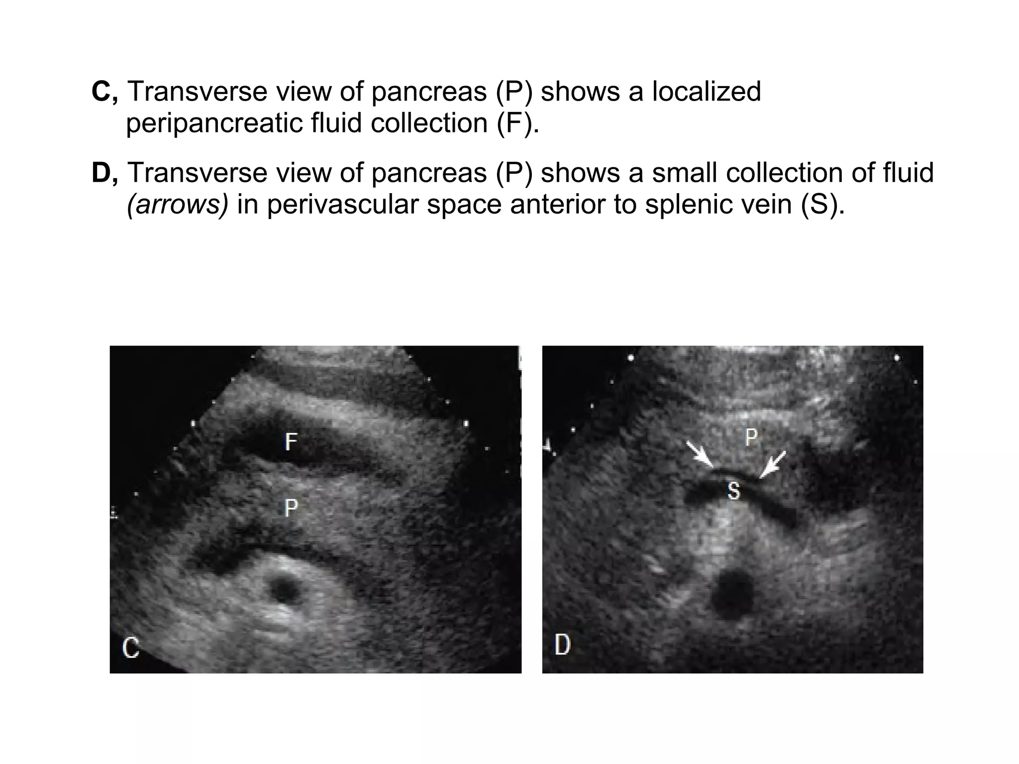 Pancreas ultrasound | PPT