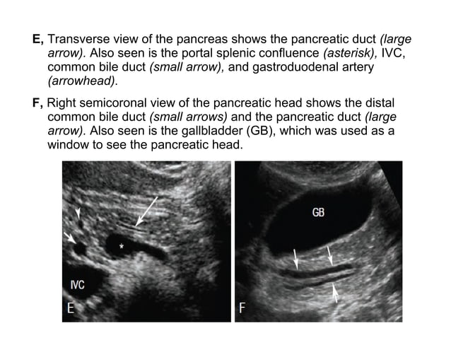 Pancreas ultrasound | PPT | Endocrine and Metabolic Diseases | Diseases ...