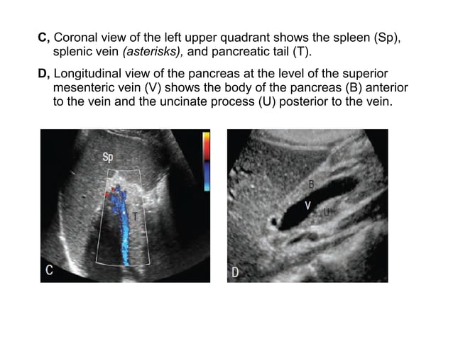 Pancreas ultrasound | PPT | Endocrine and Metabolic Diseases | Diseases ...