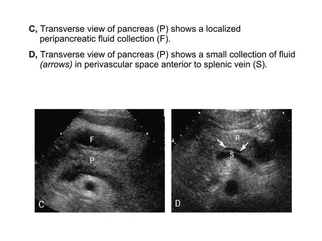 Pancreas ultrasound | PPT | Endocrine and Metabolic Diseases | Diseases ...
