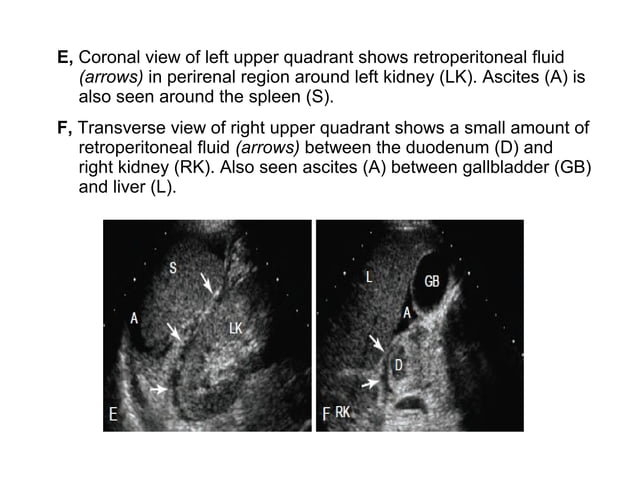 Pancreas ultrasound | PPT | Endocrine and Metabolic Diseases | Diseases ...