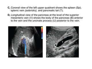 Uncinate Process Ultrasound
