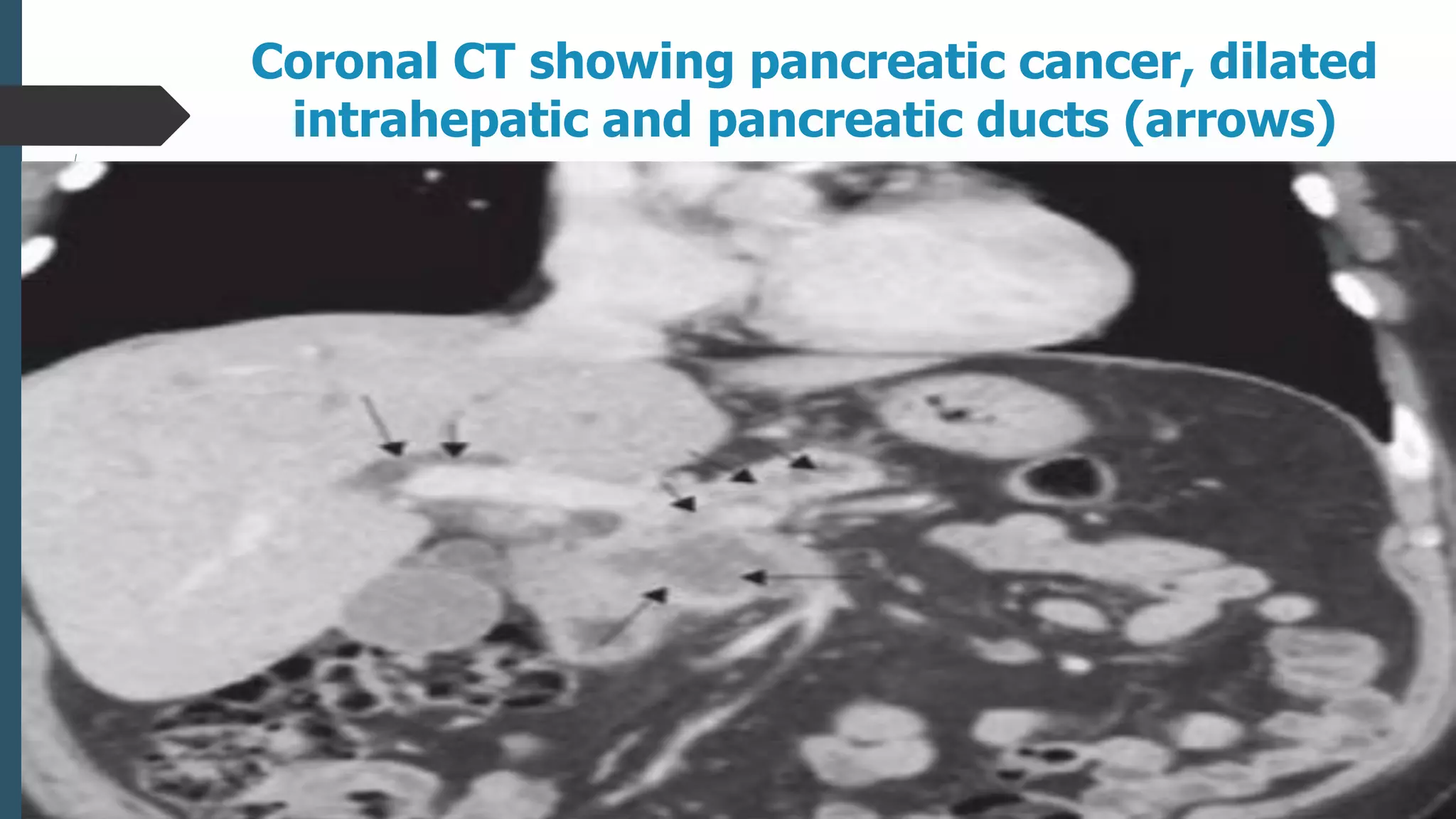 Cancer of Pancreas | PDF