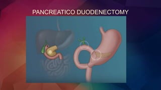 Carcinoma pancreas management | PPTX