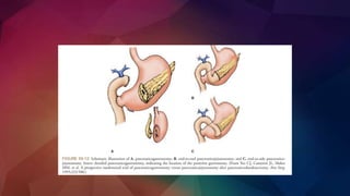 Carcinoma pancreas management | PPTX