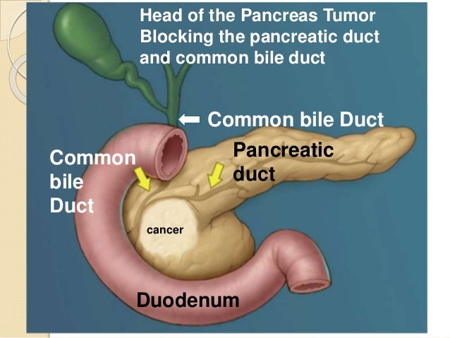 Pancreas Cancer