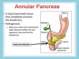 Pancreas Congenital Anomalies (agenesis, pancreas divisum, annular pancreas, ectopic pancreas ...