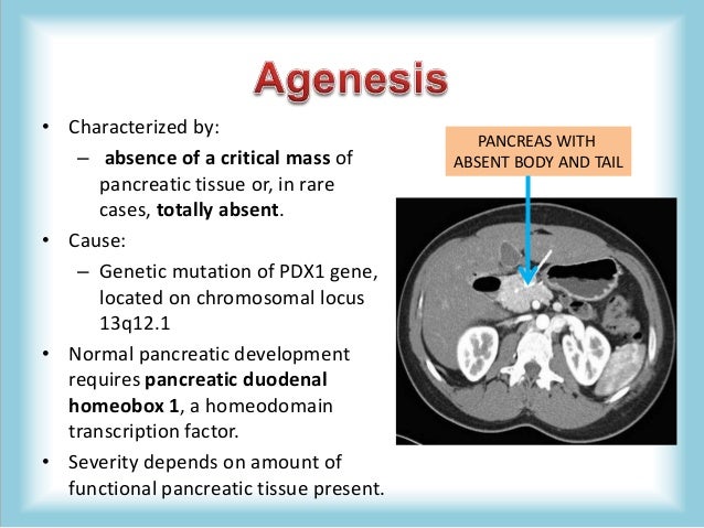 Pancreas Congenital Anomalies (agenesis, pancreas divisum, annular pa…