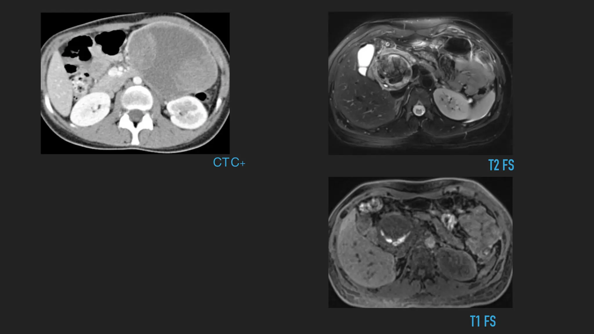 Pancreas cysts123678900008765332235568890 | PDF