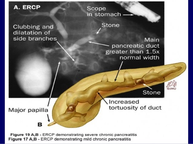 Pancreatic diseases