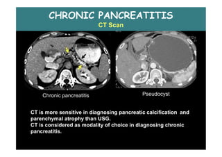 Chronic Pancreatitis Xray