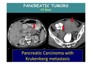 Pancreatic Carcinoma Ct