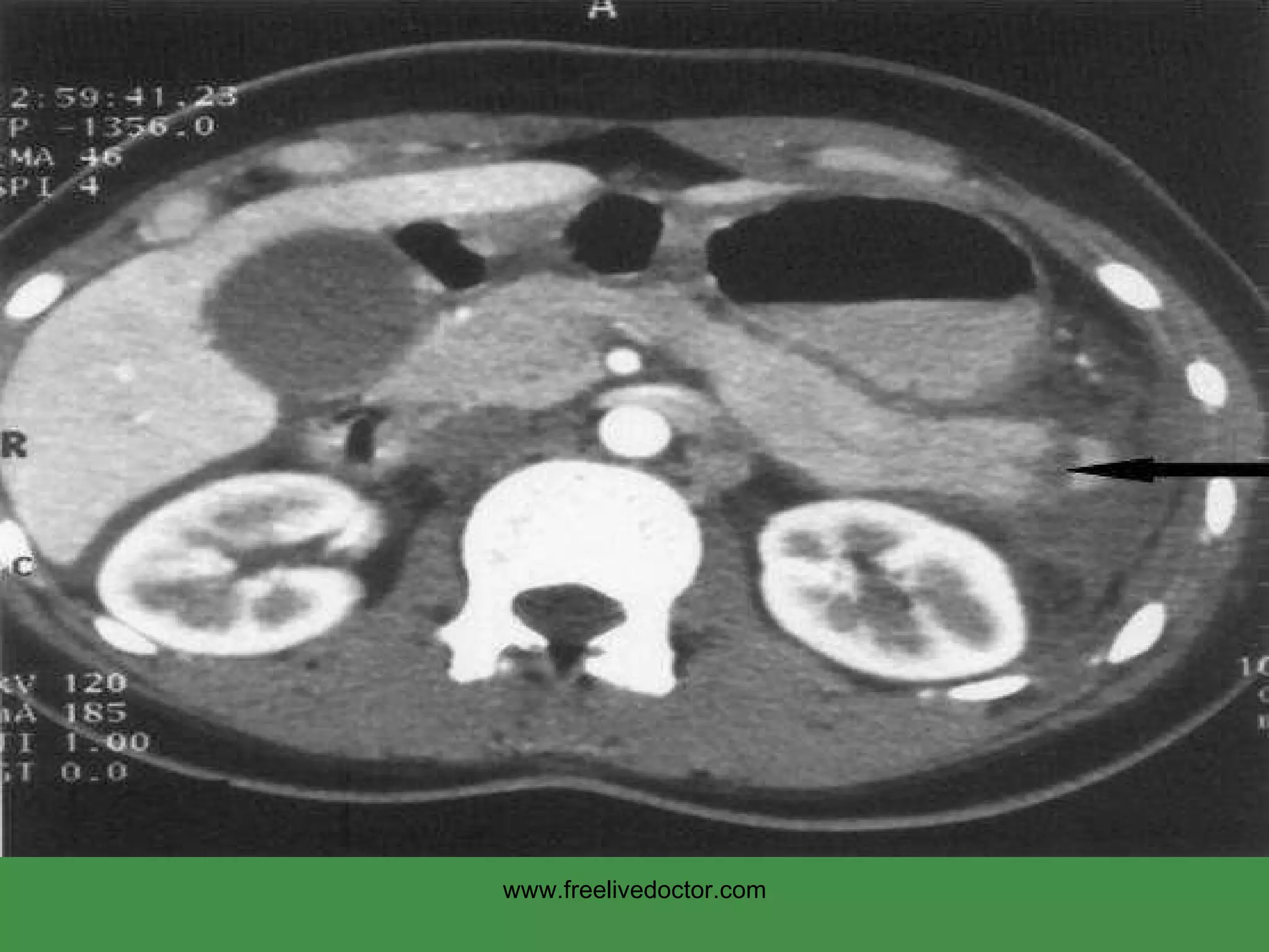 Pancreas pathology | PPT