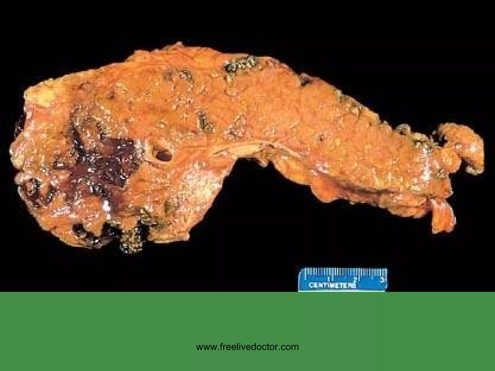 Pancreas pathology | PPT