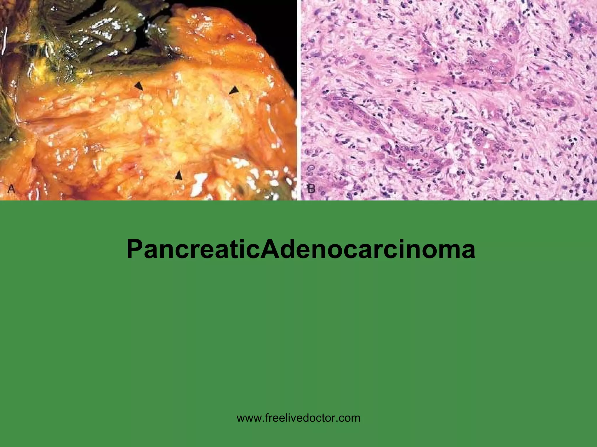 Pancreas pathology | PPT