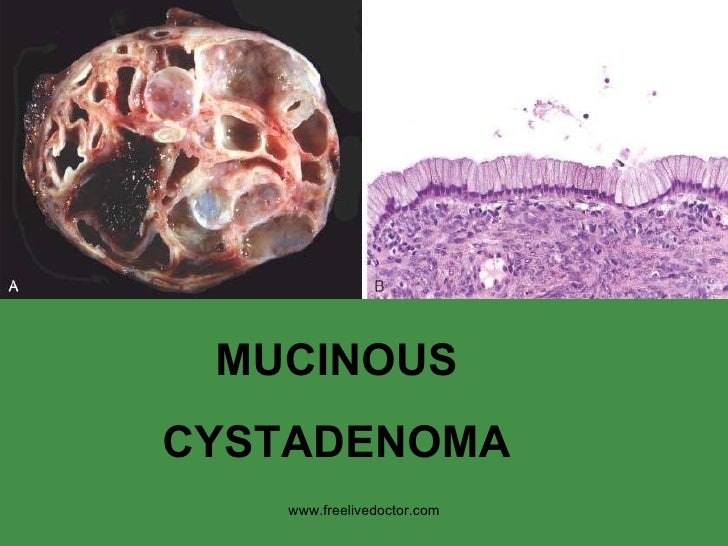 Mucinous Cystadenoma Pancreas Histology