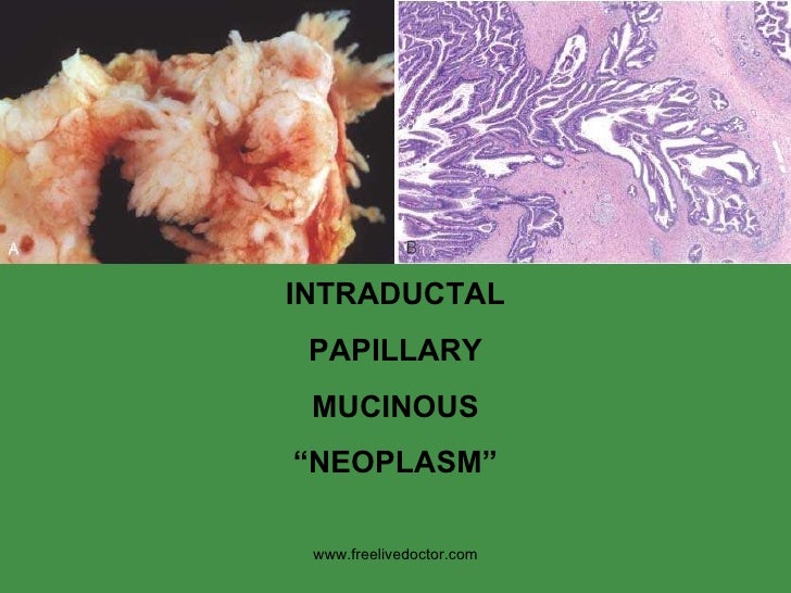 Mucinous Cystadenoma Pancreas Histology