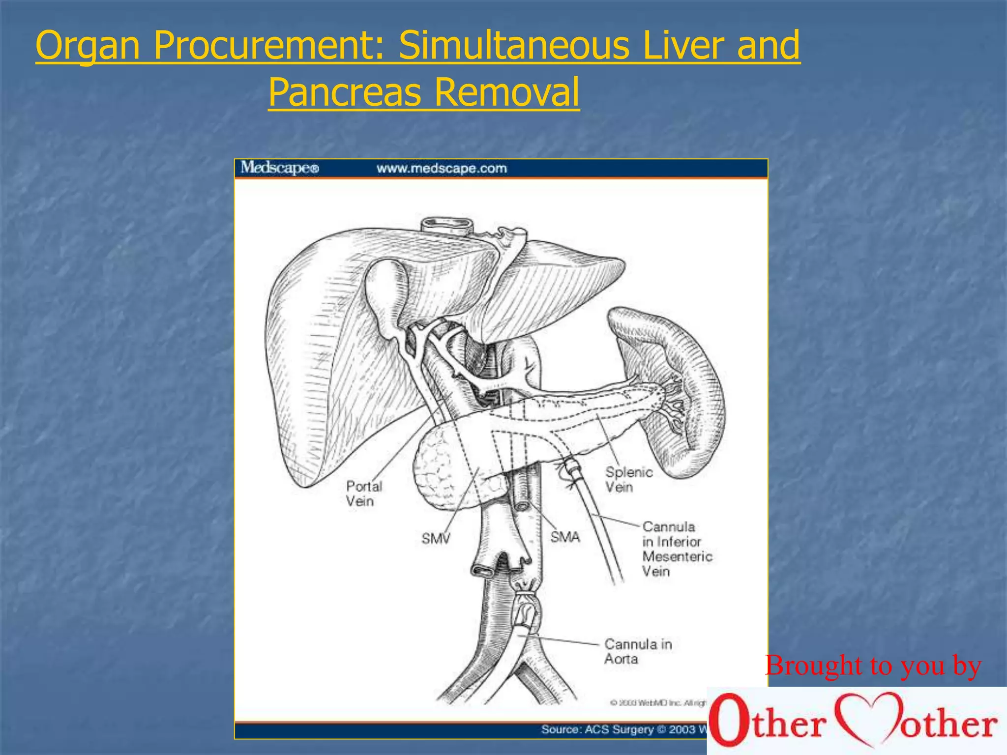 Pancreas transplantation | PPT