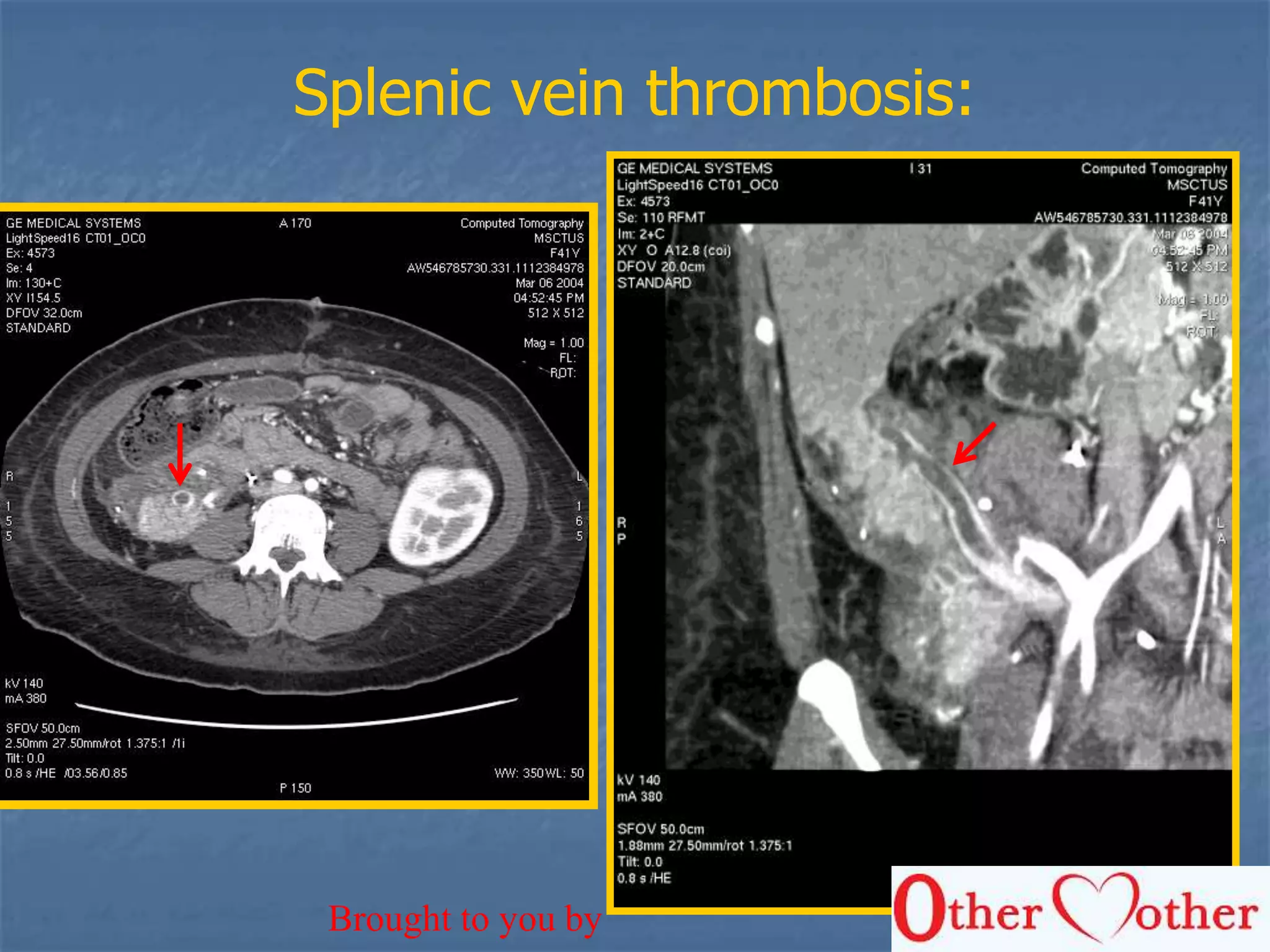 Pancreas transplantation | PPT