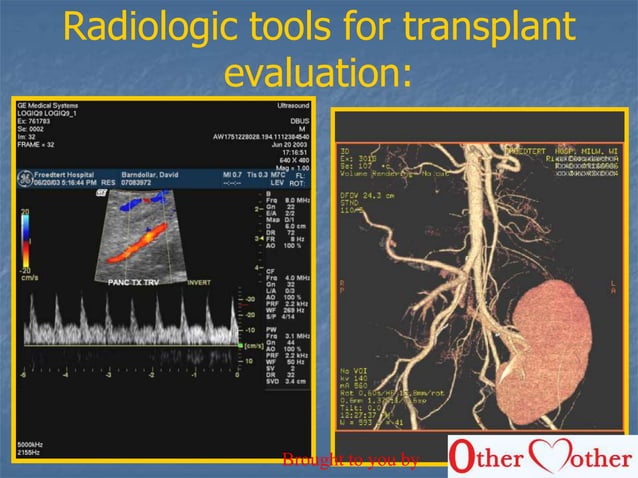 Pancreas transplantation | PPT | Endocrine and Metabolic Diseases ...