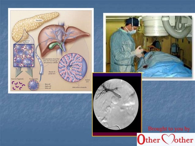 Pancreas transplantation | PPT | Endocrine and Metabolic Diseases ...