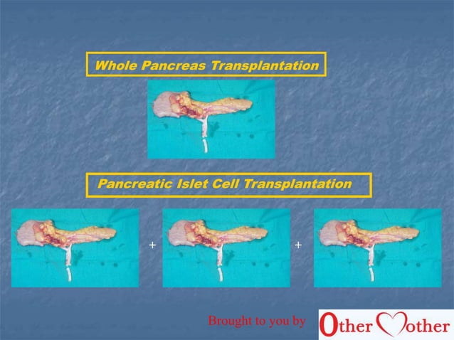Pancreas transplantation | PPT | Endocrine and Metabolic Diseases ...
