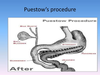 Puestow Procedure