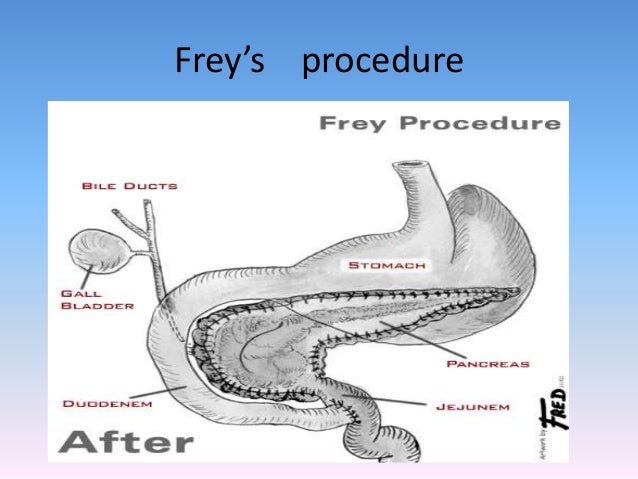 surgical management of pancreatitis