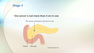 Pancreatic adenocarcinoma | PPTX
