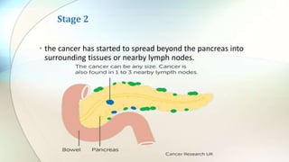 Pancreatic adenocarcinoma | PPTX