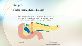 Pancreatic adenocarcinoma | PPTX