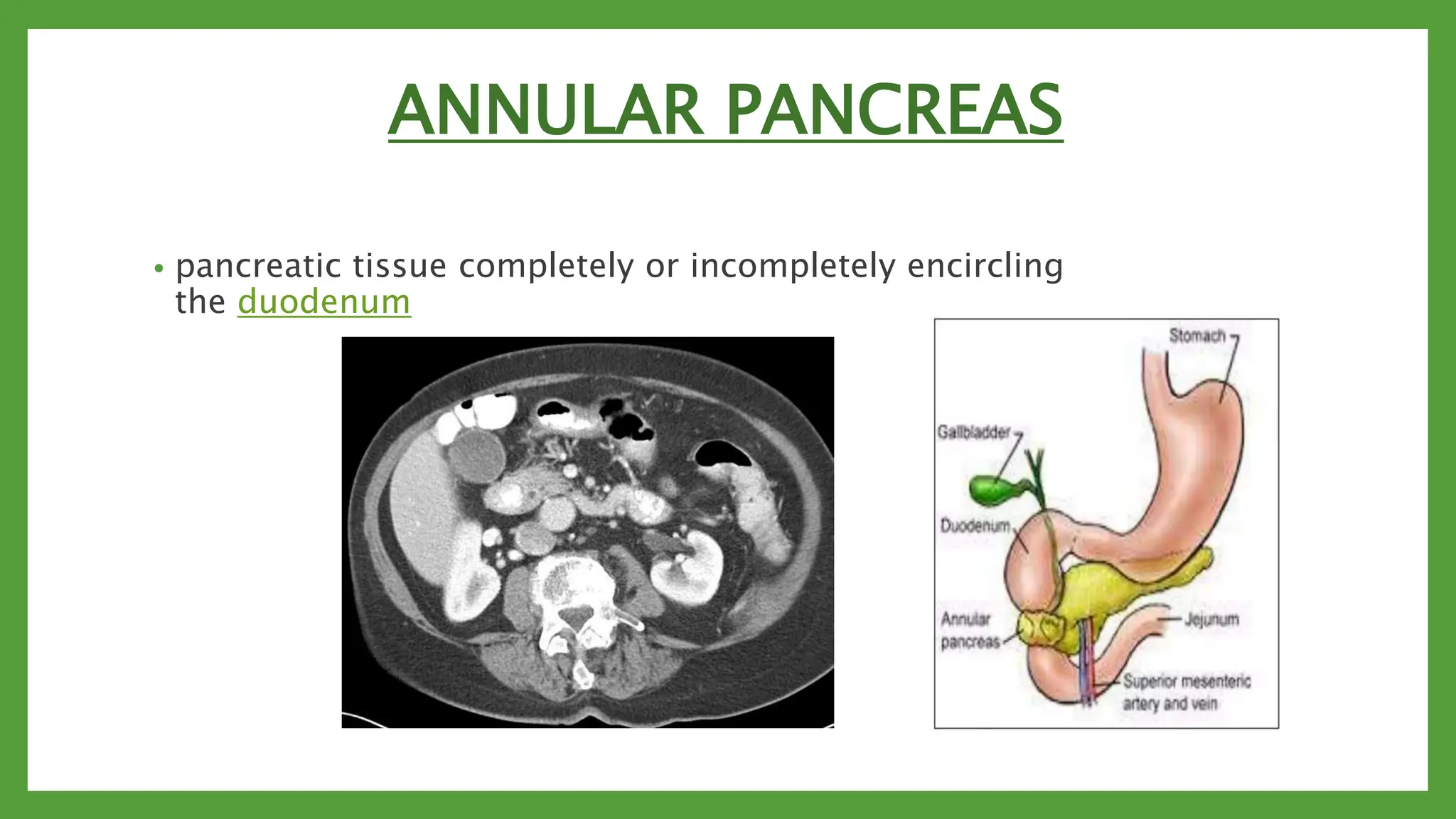 PANCREATIC ANOMALY radiology.pptx