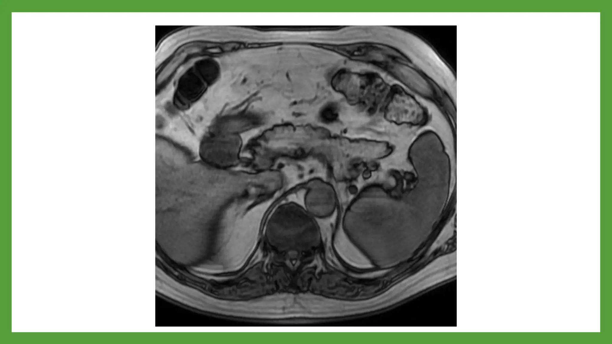 PANCREATIC ANOMALY radiology.pptx
